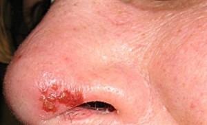 How to Treat Cold Sores Below the Nose – Coldsorescured.com